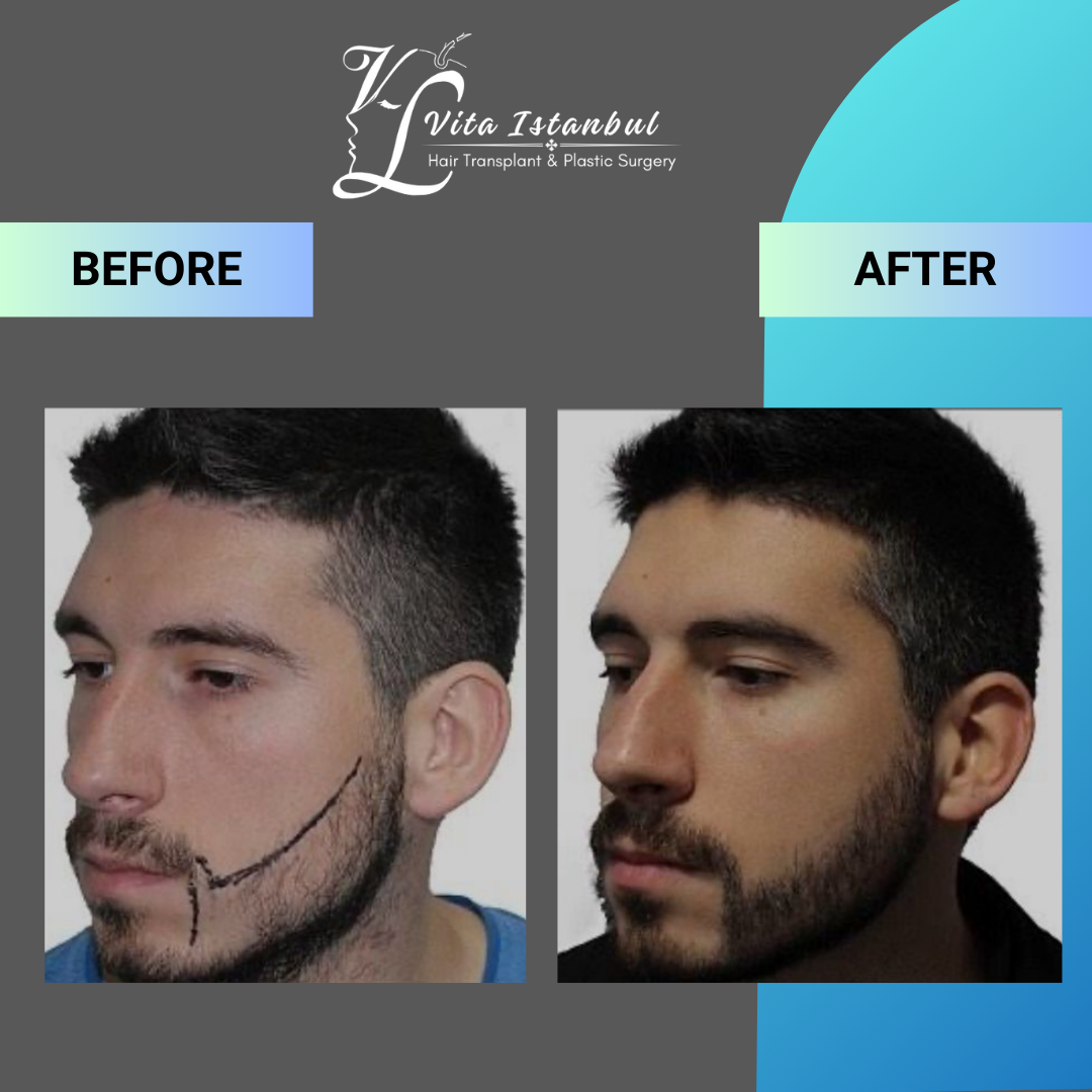 Beard Transplant - Vita Istanbul